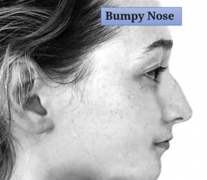 Sniff This!: The Different Types of Nose Shapes, Explained